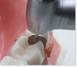 Of Using Matrix Bands to Protect The Adjacent - International Dentist ...