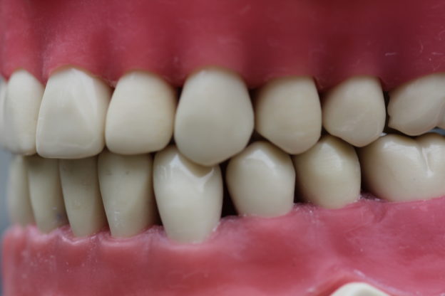 Introduction to Incisor Crown Preparation - International Dentist Central