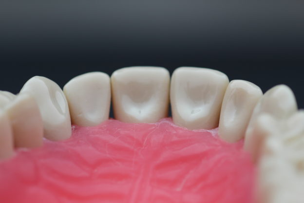 Introduction to Incisor Crown Preparation - International Dentist Central