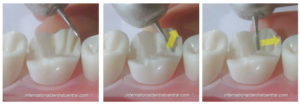 Occlusal Reduction Upper Molars – International Dentist Central