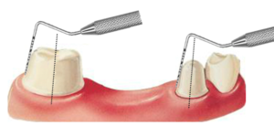 Checking for Parallelism - International Dentist Central